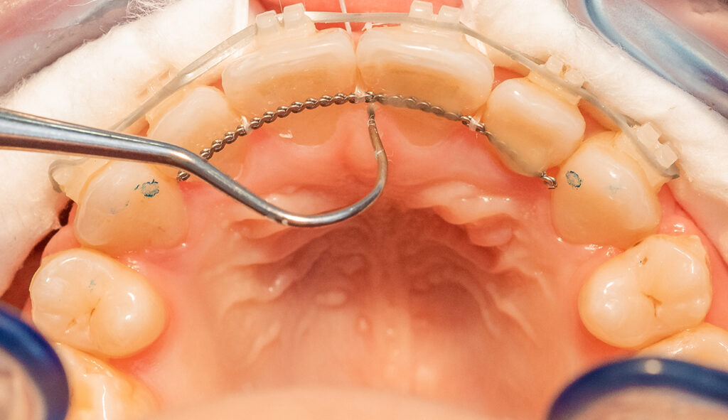 Children's Retainers | Kensington | Moira Wong Orthodontics