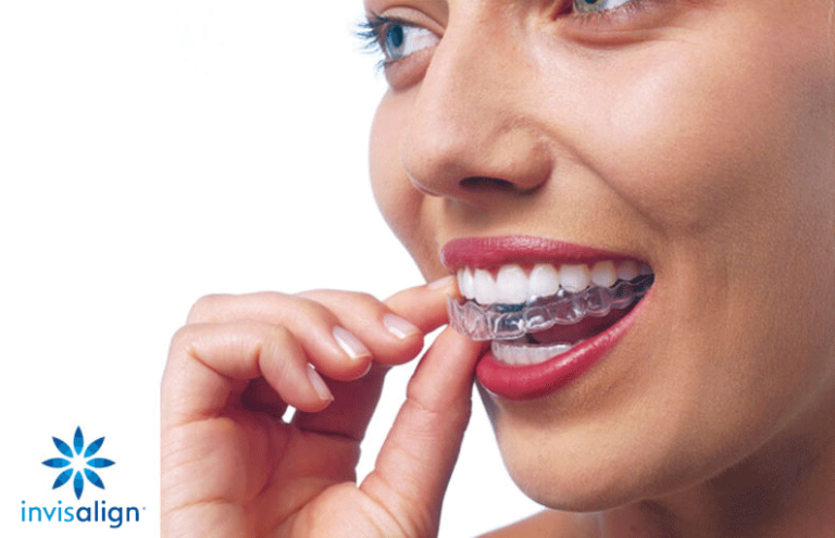 Invisalign & Carriere Motion Appliance | Moira Wong trading as Moira ...